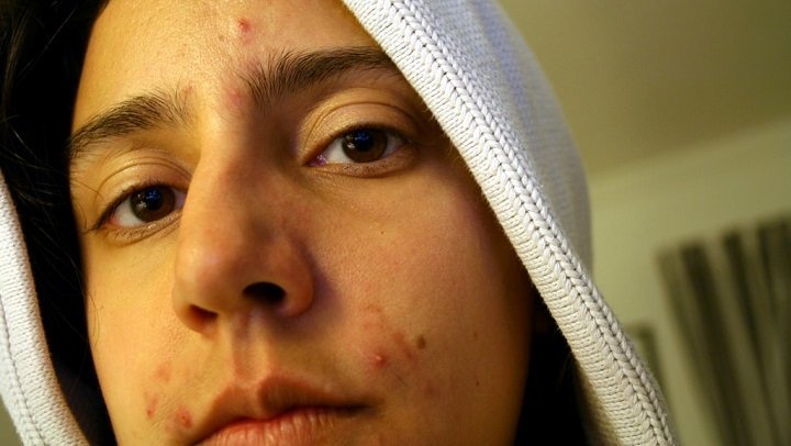 Home Remedies for Teenage Acne, How to Get Rid of Teen Pimples Naturally