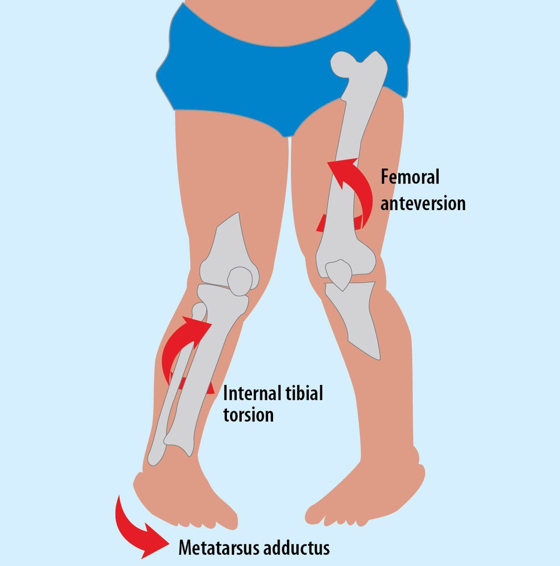 Does Your Child Sit In A W-pattern? W Pattern Sitting: What is it? Why ...