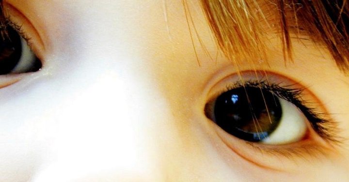 Lazy Eye Syndrome and Symptoms in Children, Amblyopia Causes and ...