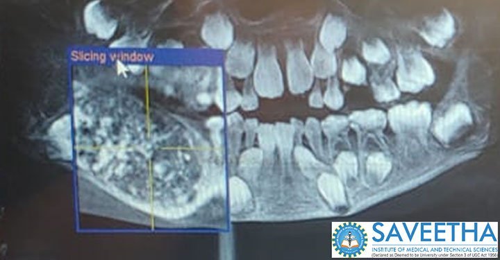 The boy with 526 teeth